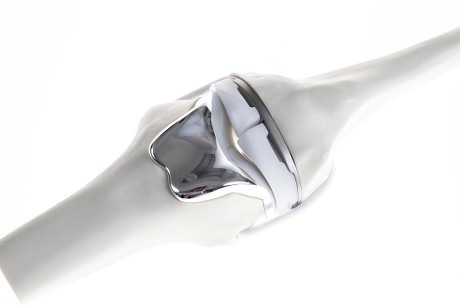 Knee Prosthesis Knee Endoprosthesis Knee Joint - Foto de stock de ...