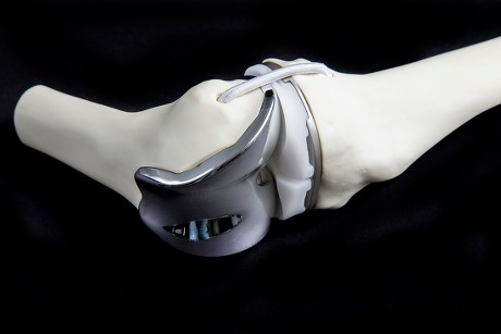 Knee Prosthesis Knee Endoprosthesis Knee Joint Editorial Stock Photo ...