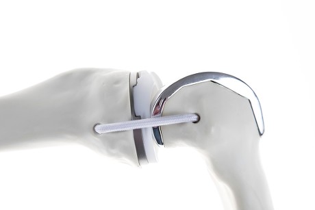 Knee Prosthesis Knee Endoprosthesis Knee Joint Redaktionelles Stockfoto ...