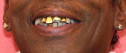 500 Gold teeth Stock Pictures, Editorial Images and Stock Photos ...