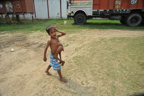 Eight Limbed Boy Deepak Kumar Editorial Stock Photo - Stock Image | Shutterstock