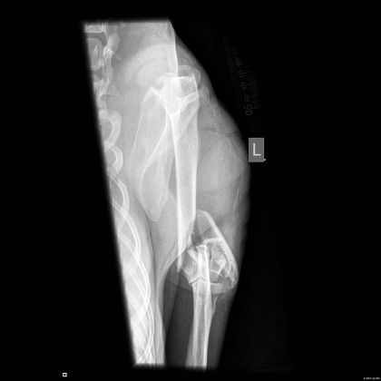 Xray Rubys Humerus Fracture Editorial Stock Photo - Stock Image ...
