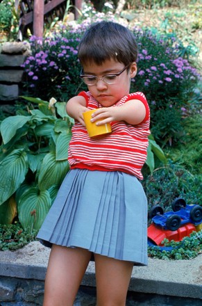Young Girl W Arms Deformed Thalidomide Editorial Stock Photo - Stock ...