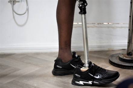Prosthetic Leg Affixed Child Irede Prosthetic Editorial Stock Photo ...