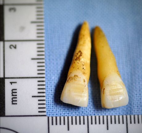 Teeth Featuring Horizontal Grooves Recovered Mass Editorial Stock Photo ...