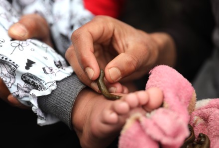 Child Undergoes Leech Therapy Session On Editorial Stock Photo - Stock ...