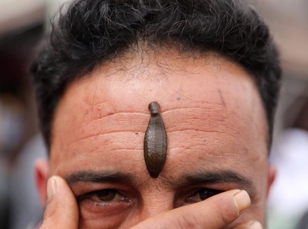 Person Undergoes Leech Therapy Session On Editorial Stock Photo - Stock ...