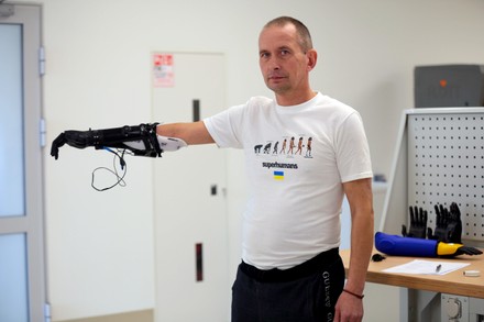One First Patients Gets Familiar Prosthetic Editorial Stock Photo ...