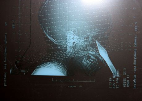 Xray Showing Gate Spike Embedded Li Editorial Stock Photo - Stock Image ...