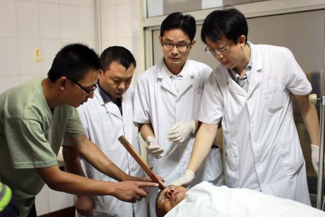 Man gets wooden chair leg impaled through head during fight, Yantai ...