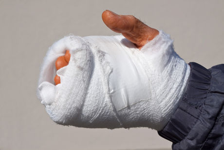Model Released Recently Operated Hand Bandaged Editorial Stock Photo ...