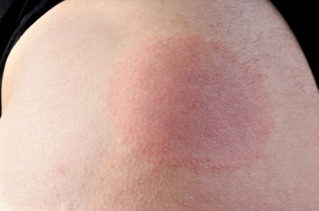 Model Released Skin Rash Erythema Migrans Redaktionelles Stockfoto ...