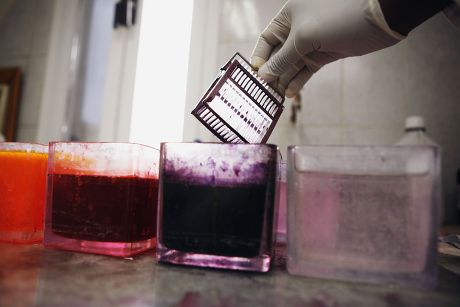 Hand Pathologist Removing Set Slides Dye Editorial Stock Photo - Stock ...