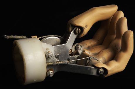 Cable Operated Prosthetic Hand Editorial Stock Photo - Stock Image ...