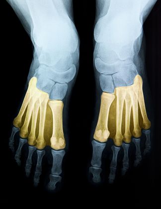 Foot X Ray Editorial Stock Photo - Stock Image | Shutterstock