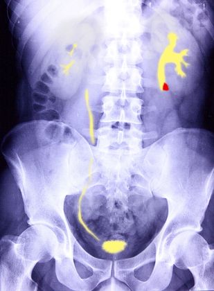 Kidney Stone X Ray Editorial Stock Photo - Stock Image | Shutterstock