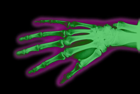 Hand X Ray Editorial Stock Photo - Stock Image | Shutterstock