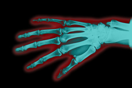 Hand X Ray Editorial Stock Photo - Stock Image | Shutterstock