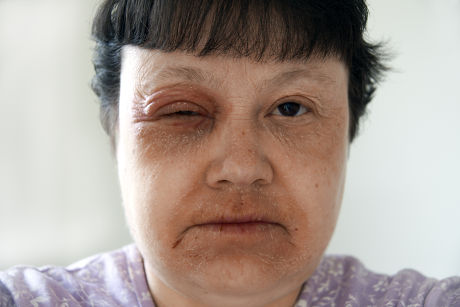 Model Released Woman Suffering Eczema Rash Editorial Stock Photo ...