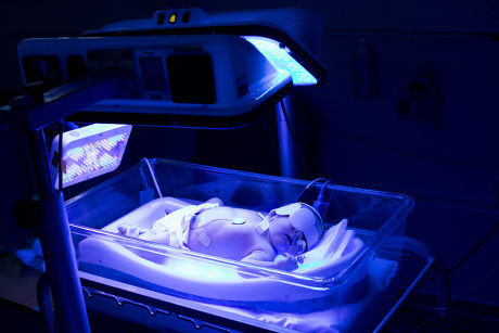 Baby Treated Jaundice Using Ultraviolet Light Editorial Stock Photo ...