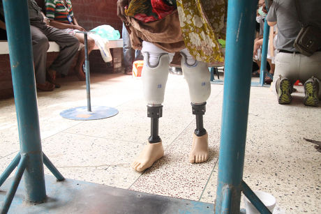 Amputee Tries Walk Prosthetic Legs National - Foto de stock de ...