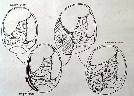Diagram Showing How Tissue Expander Worked Editorial Stock Photo ...
