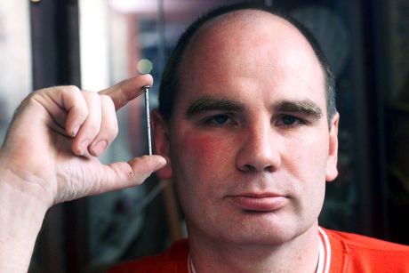 ANTHONY SMART OF CWMFELINFACH , WALES, WHO HAD NAIL EMBEDDED IN HIS ...