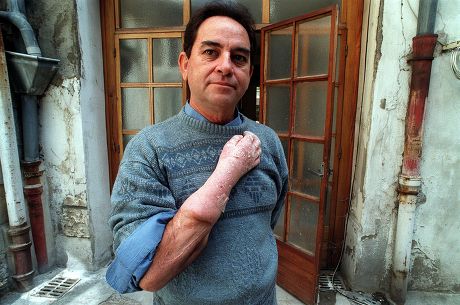 Clint Hallam First Hand Transplant Patient Editorial Stock Photo ...