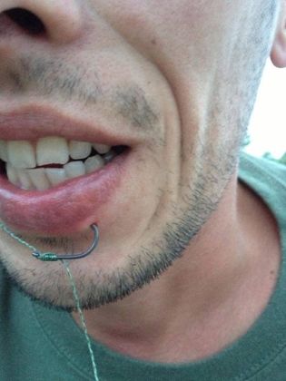 __COUNT__ Angler gets fish hook embedded in chin, Surrey, Britain - 05 ...