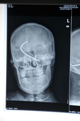 Xray Showing Rod Impaled Ha Weis Editorial Stock Photo - Stock Image ...