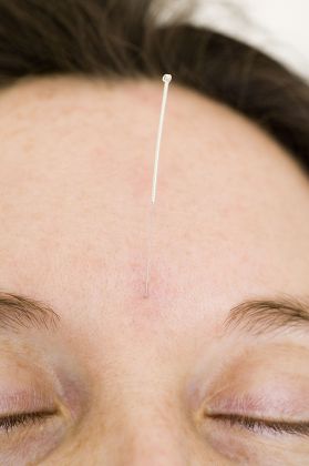Model Released Acupuncture Needles Fine Hair Editorial Stock Photo ...
