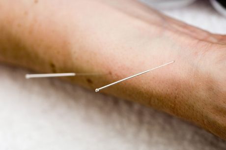 250 Acupuncturist Stock Pictures, Editorial Images and Stock Photos ...