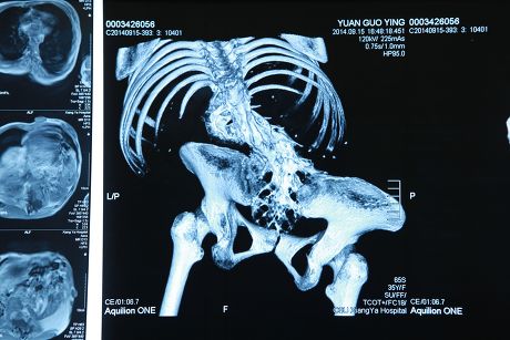 Xray Showing Yans Distorted Spine Editorial Stock Photo - Stock Image ...