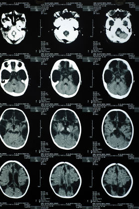 Closeup Series Ct Scans Showing Infants Editorial Stock Photo - Stock ...
