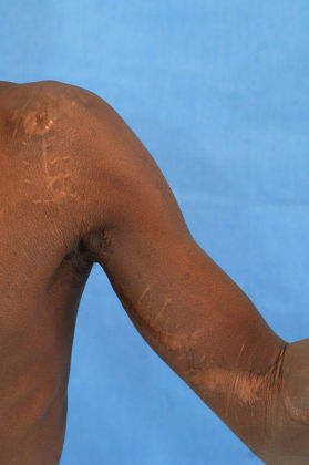24 Wound marks Stock Pictures, Editorial Images and Stock Photos ...