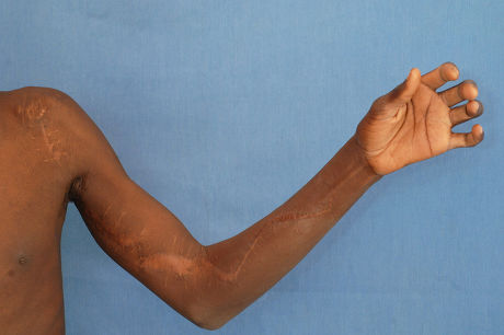 Scarring Tissue Damage Caused By Burning Editorial Stock Photo - Stock ...