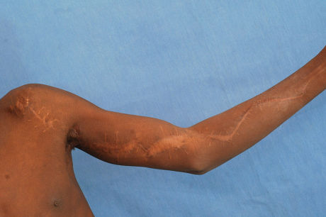 24 Wound marks Stock Pictures, Editorial Images and Stock Photos ...