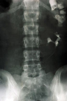 Xray Showing Ectopic Kidney Ectopic Kidney Editorial Stock Photo ...