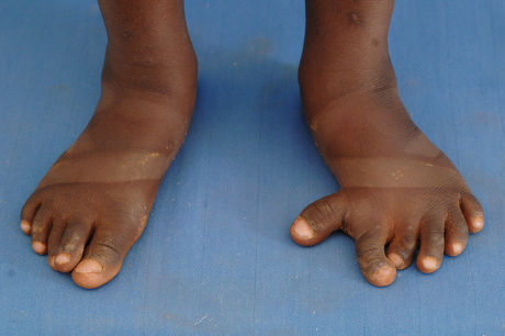Patient Has Congenital Deformity Extra Toe Editorial Stock Photo ...