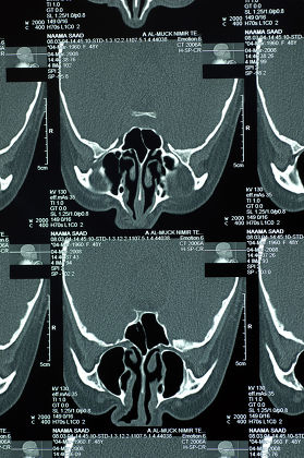 Closeup Series Ct Scans Showing Infants Editorial Stock Photo - Stock ...