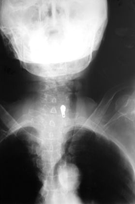 Model Released Xray Goitre Swelling Thyroid Editorial Stock Photo ...