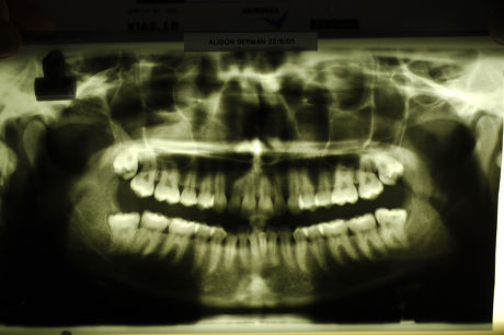 Dental Xrays Showing Teeth Editorial Stock Photo - Stock Image ...
