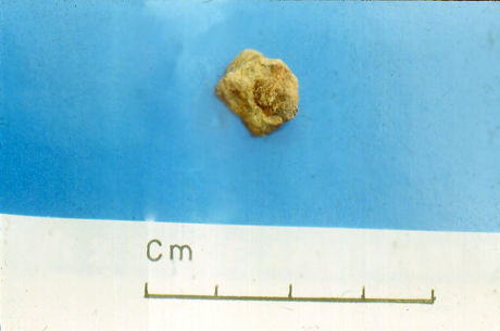 41 Gallstone Stock Pictures, Editorial Images and Stock Photos ...