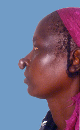 Patient Has Keloid Scar On Face Editorial Stock Photo - Stock Image ...