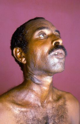 Patient Has Keloid Scar On Neck Editorial Stock Photo - Stock Image ...