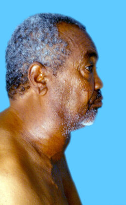 Patient Has Multinodular Goitre Swelling Neck Editorial Stock Photo ...