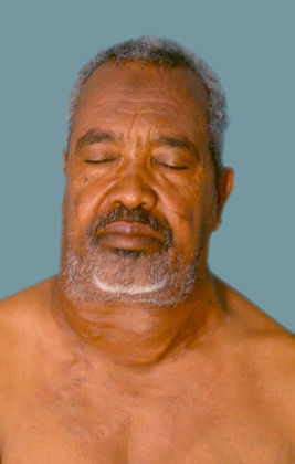 Patient Has Multinodular Goitre Swelling Neck Editorial Stock Photo ...