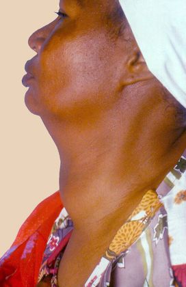 Patient Has Multinodular Goitre Swelling Neck - Foto de stock de ...