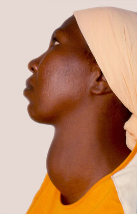 Patient Has Multinodular Goitre Swelling Neck Editorial Stock Photo ...