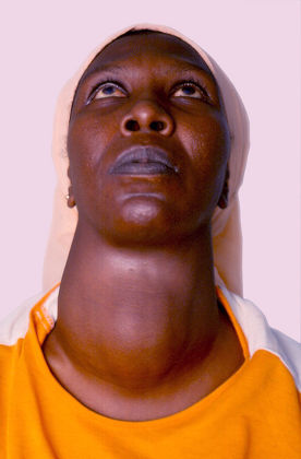 Patient Has Multinodular Goitre Swelling Neck Editorial Stock Photo ...